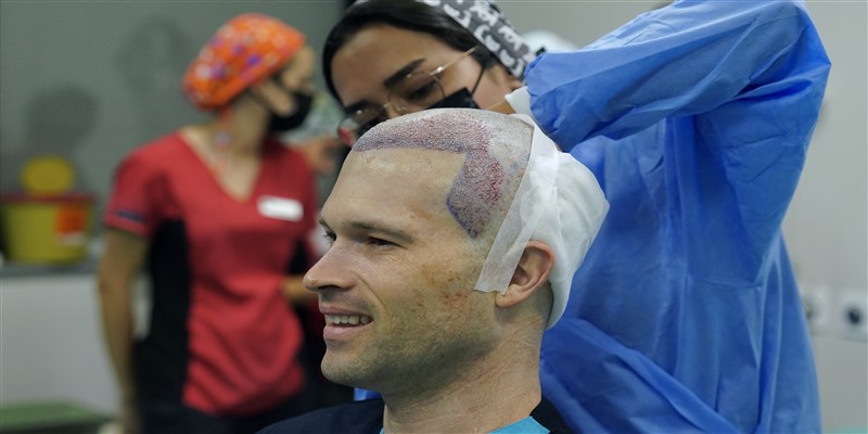 10 Days After Hair Transplant Asmed Hair Transplant