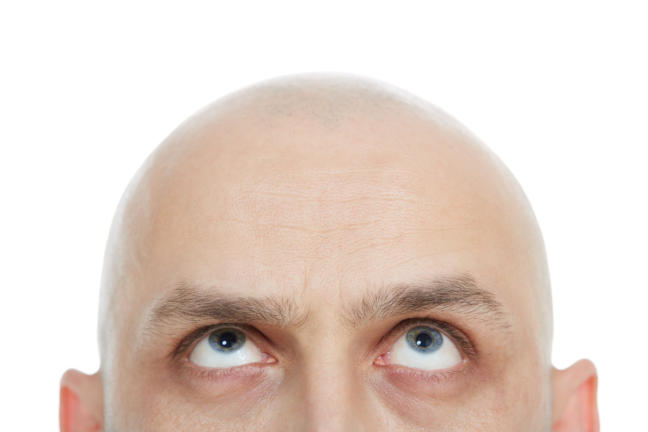 Excessive Hair Loss - Asmed Hair Transplant