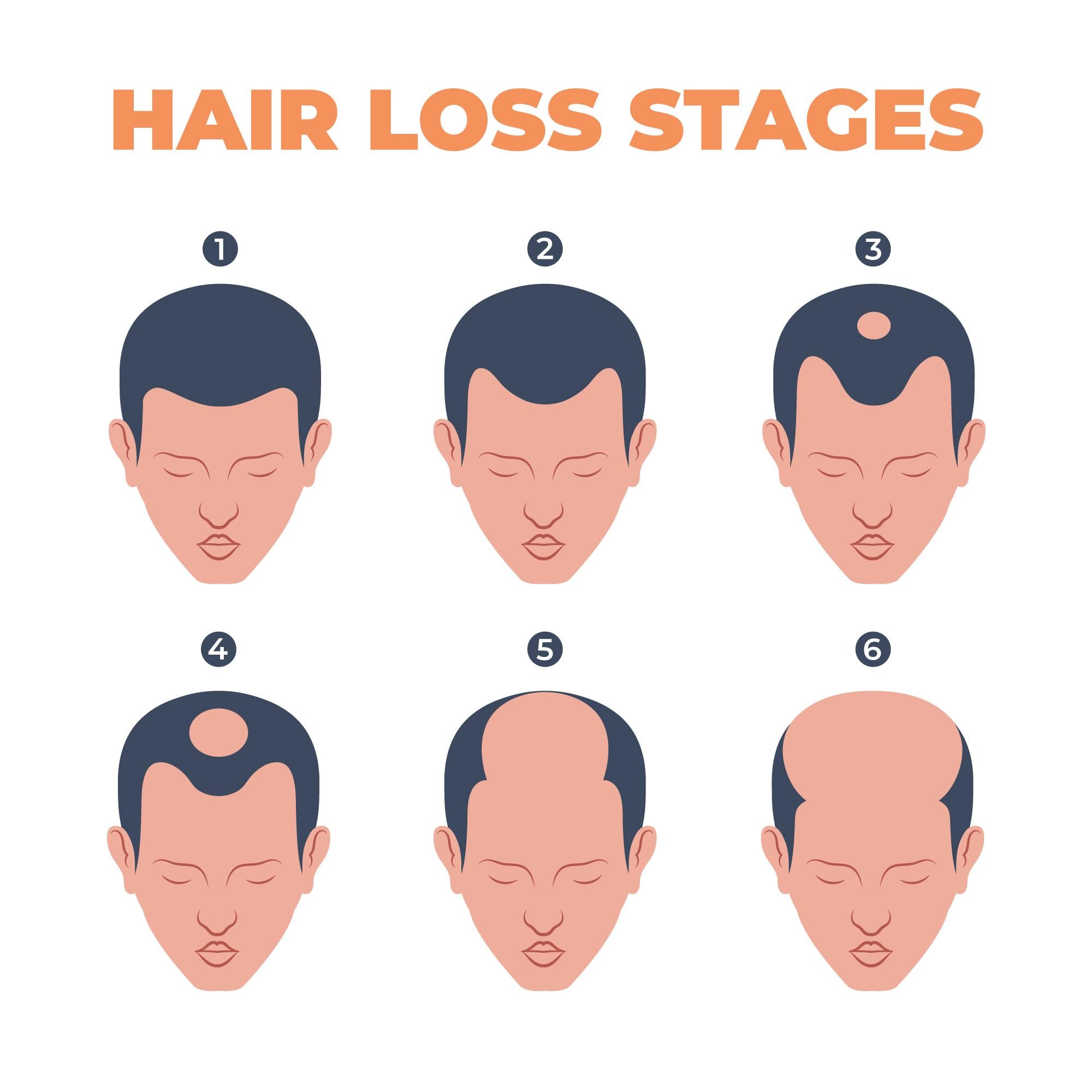 Hair Loss Patterns - Asmed Hair Transplant