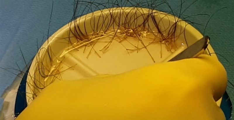 Fue Without Shaving Head - Asmed Hair Transplant