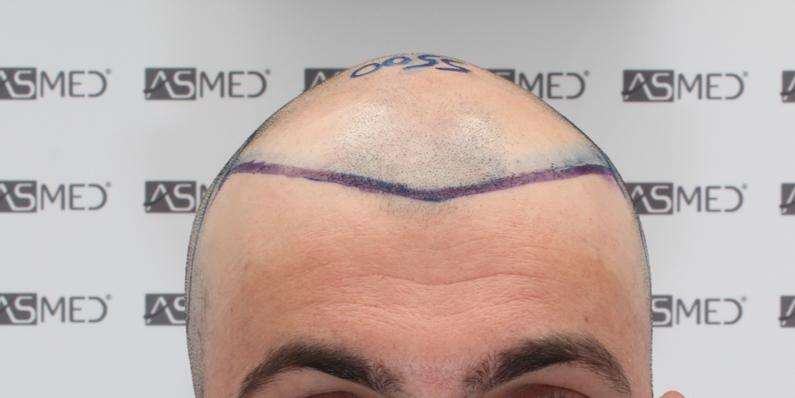 Hairline Transplant Turkey - Asmed Hair Transplant