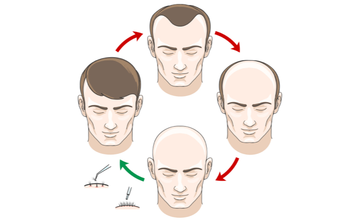 What Is Male Pattern Baldness? Types, Causes and Treatments