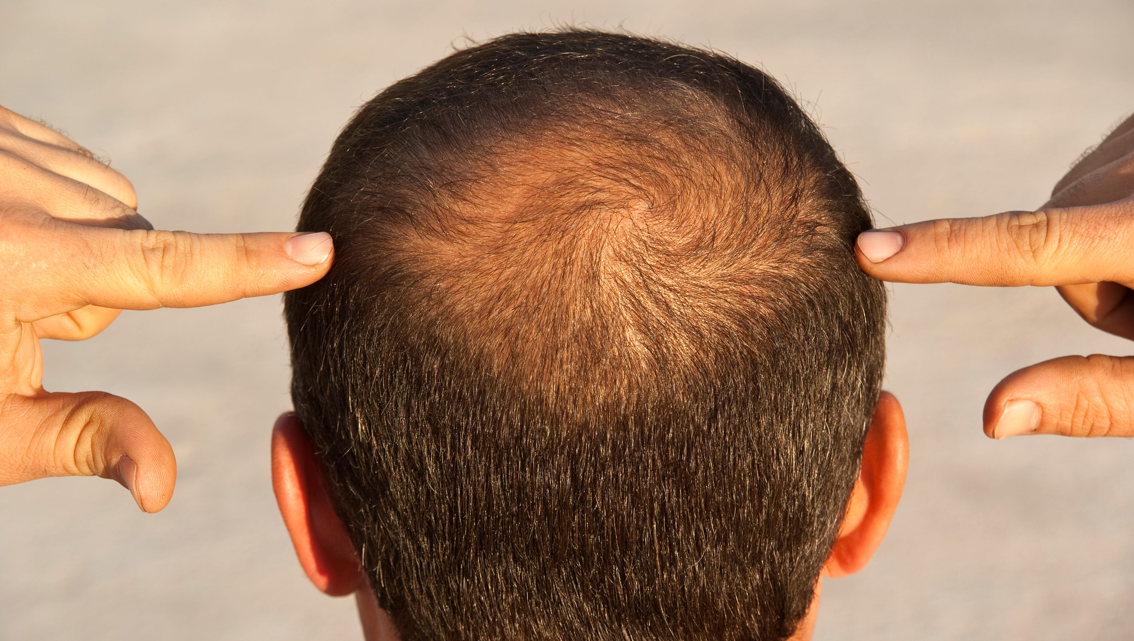 What is Male Pattern Baldness? - Asmed Hair Transplant